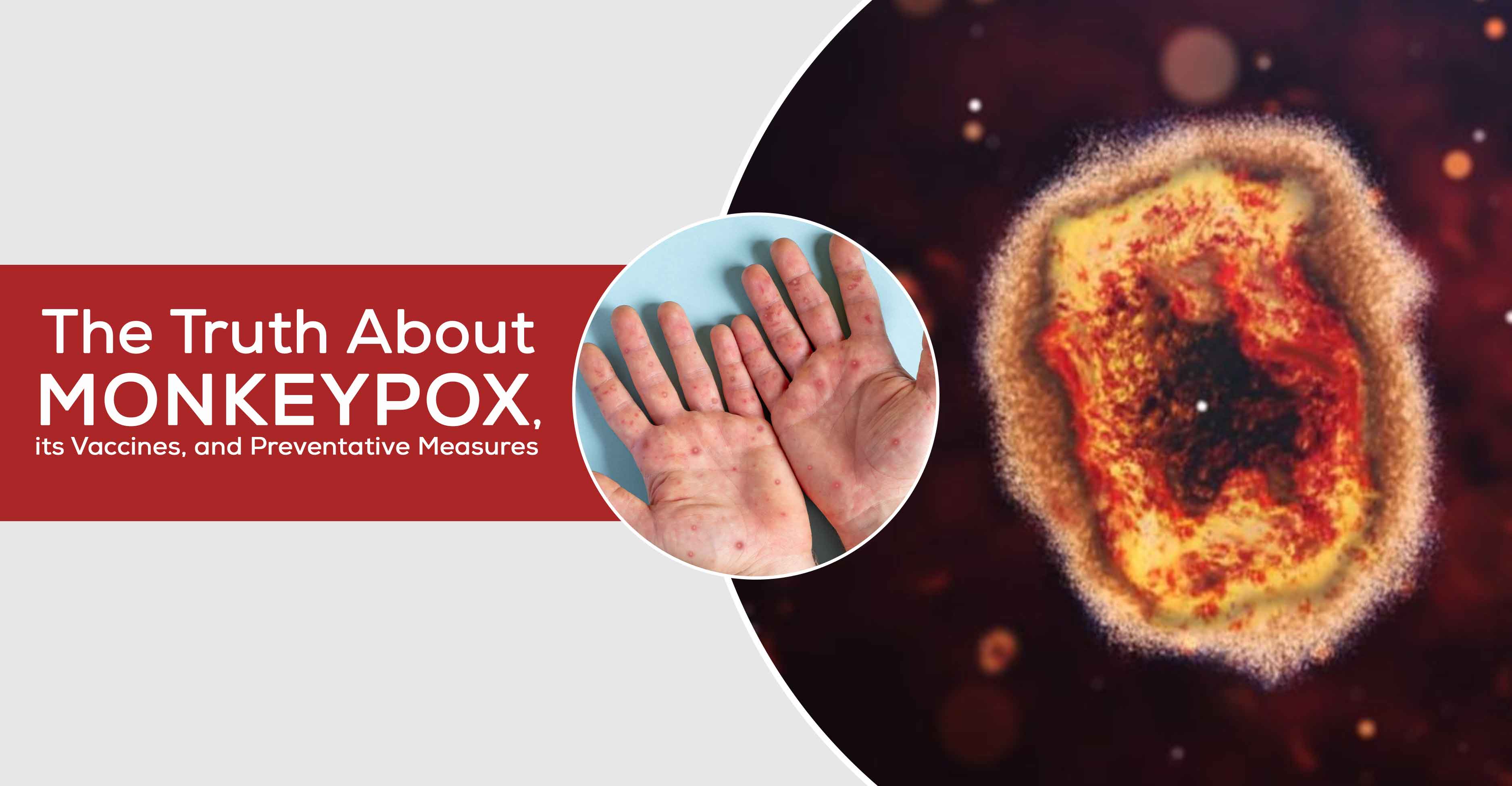 The Truths About Monkeypox, its Vaccines, and Preventative Measures ...